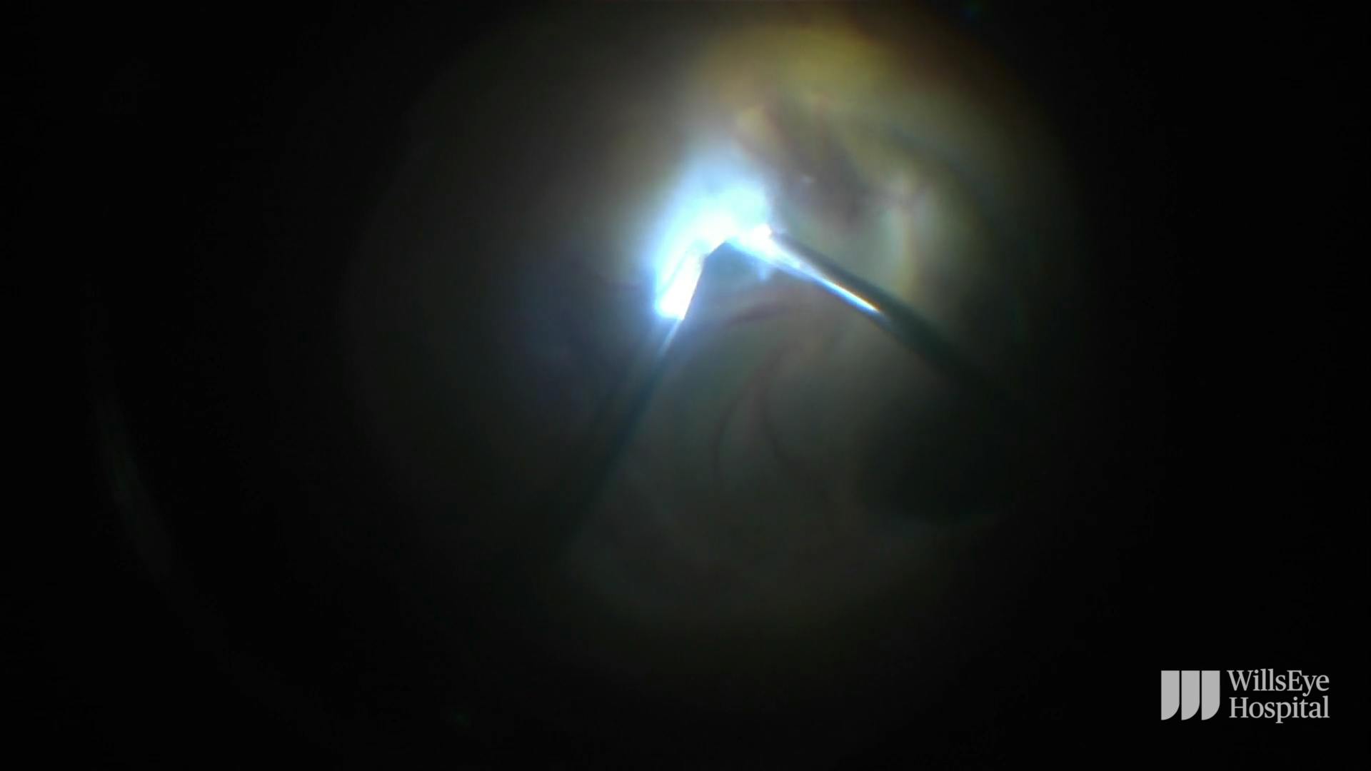 Surgery for an Infant With Stage-5 Familial Exudative Vitreoretinopathy - Eyetube